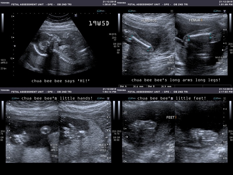 Anatomy Scan 21 Weeks